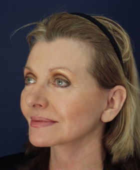 Facelift Surgery Before & After Photos | Dr. Adam Basner