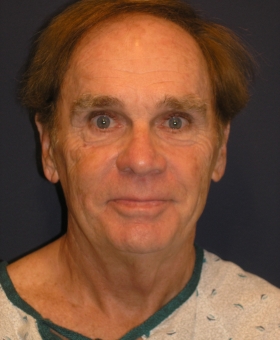 Facelift Before & After Photos - Dr. Adam Basner