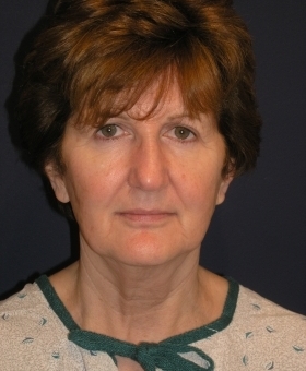 Before and After Gallery