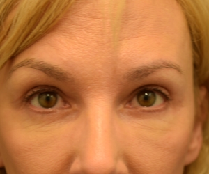 Blepharoplasty Before & After Photos - Dr. Adam Basner