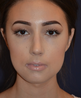 Plastic Surgery Before & After | Find Top Plastic Surgeon Before ...