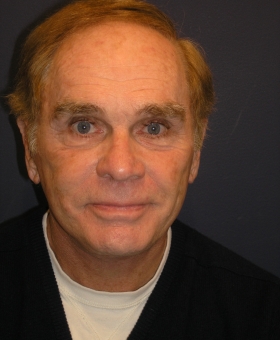 Facelift Before & After Photos - Dr. Adam Basner