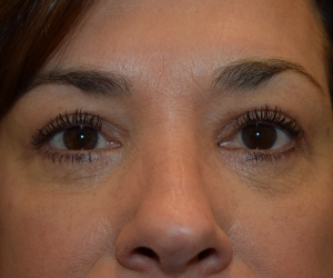 Blepharoplasty Before & After Photos - Dr. Adam Basner