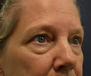 Blepharoplasty (Eyelid Surgery) Before & After Gallery | Dr. Adam Basner
