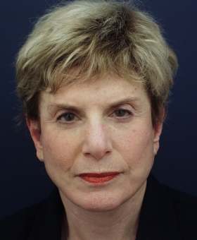 Facelift Surgery Before & After Photos | Dr. Adam Basner