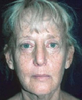 Facelift Surgery Before & After Photos | Dr. Adam Basner