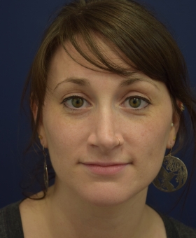 Rhinoplasty (Nose Job) Before & After | Dr. Adam Basner