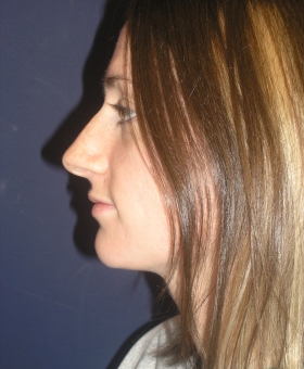 Rhinoplasty (Nose Job) Before & After | Dr. Adam Basner