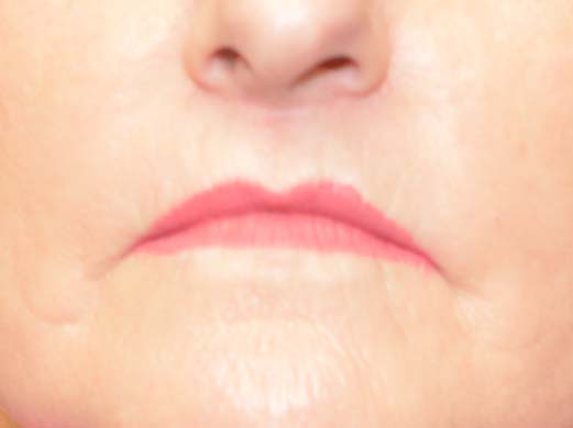 Upper Lip Lift