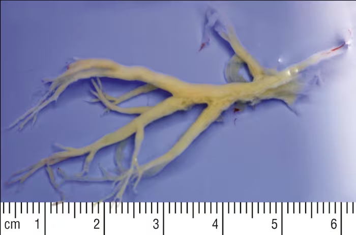 Plastic Bronchitis Lawyers in Philadelphia, Pa.