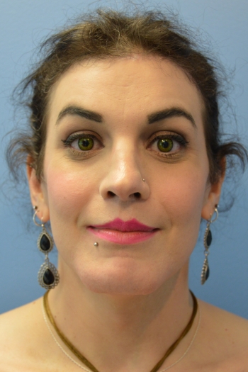 Gallery of Transgender Face | Zinsser Plastic Surgery