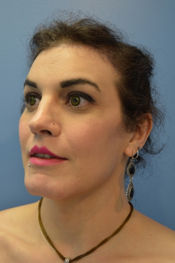 Gallery of Transgender Face | Zinsser Plastic Surgery